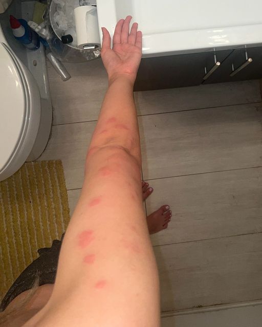 Identifying 10 Common Bug Bites and How to Recognize Them - Weveryday ...
