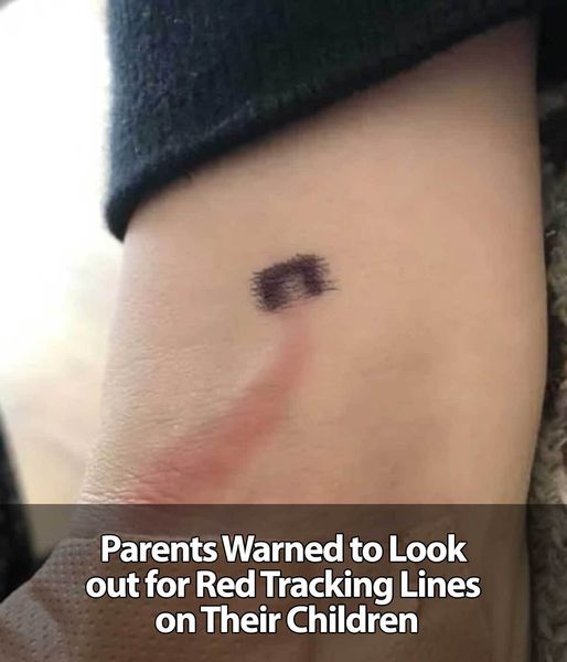 Parents, Watch for Red Tracking Lines on Your Children’s Skin ...