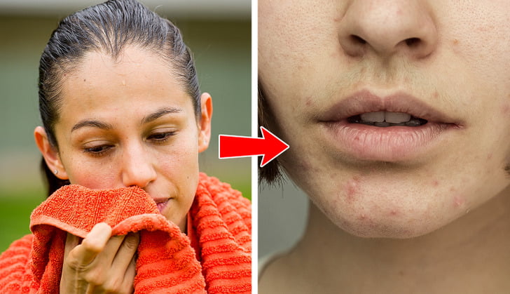 How Acne on These 5 Body Parts Reflects Your Daily Habits - Weveryday ...