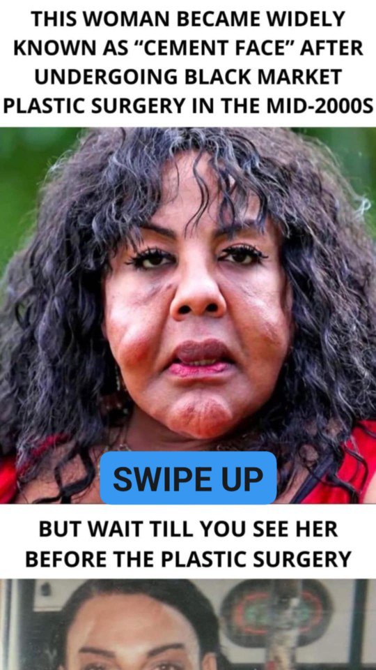 Injected with Cement: Her Unbelievable Transformation 14 Years Later ...