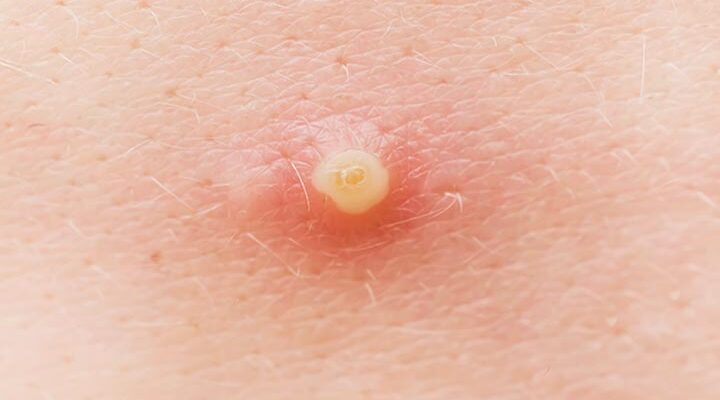 Body Acne: 10 Tips To Get Rid Of Them - Weveryday Stories