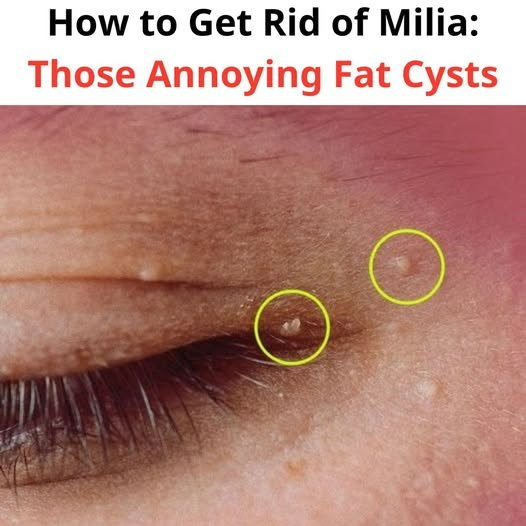 How to Get Rid of Milia: Those Annoying Fat Cysts - Weveryday Stories