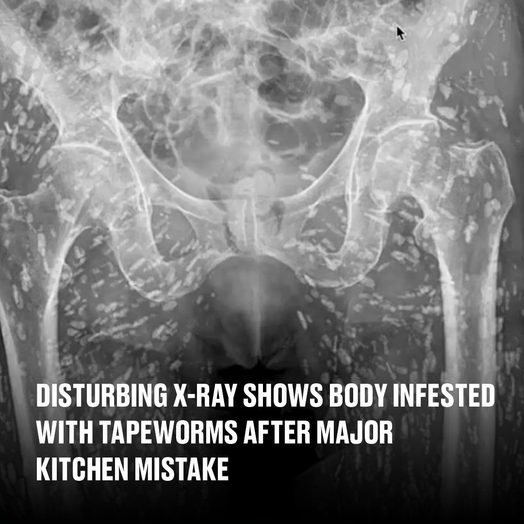 A Disturbing X-ray Reveals the Hidden Dangers of a Kitchen Problem ...