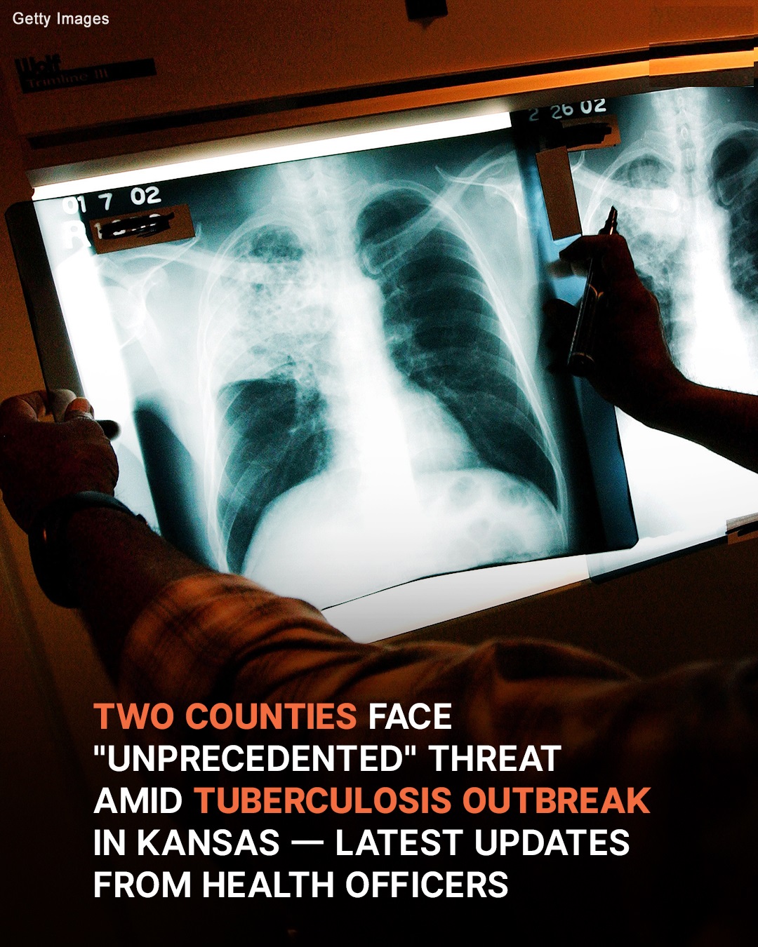 Kansas Tuberculosis Outbreak, Largest in US History, Hits 67 Active ...