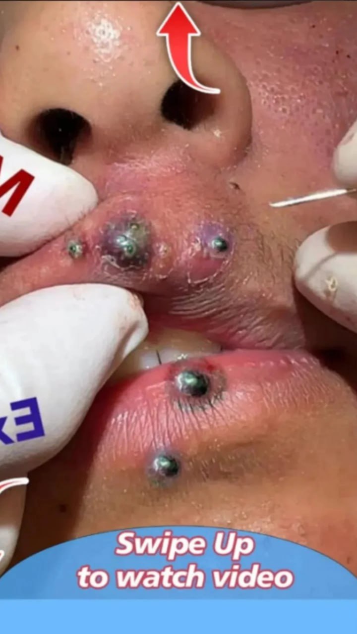 Big Cystic Acne Blackheads Extraction Blackheads & Milia, Whiteheads ...