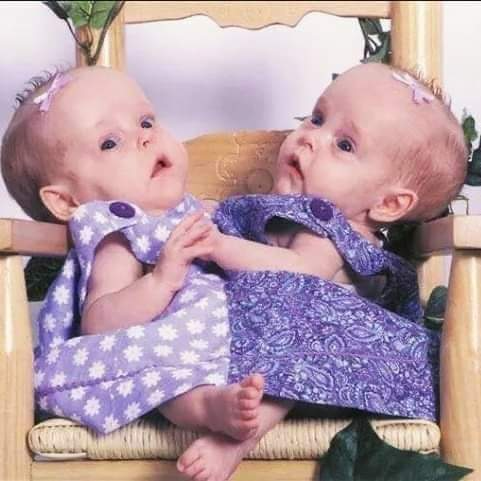 10 years ago, they were born conjoined twins, and the DOCTORS ...