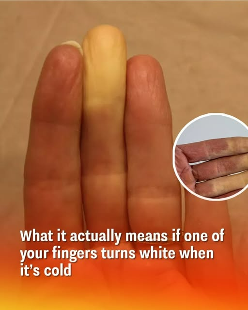 Why Your Finger Turns White in the Cold: What’s Really Happening ...