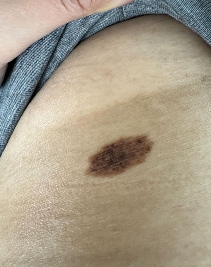 There’s a mole on my skin that has some patchy dark areas. - Weveryday ...