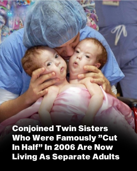 Conjoined Twins Bella And Abby Were Genuinely Associated From Birth ...