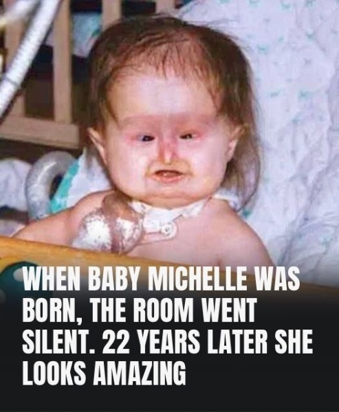 Baby Born With Unusual Syndrome – 22 Years Later She Looks Amazing ...