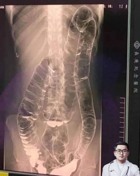 Here’s What You Need To Know About Chronic Constipation - Weveryday Stories