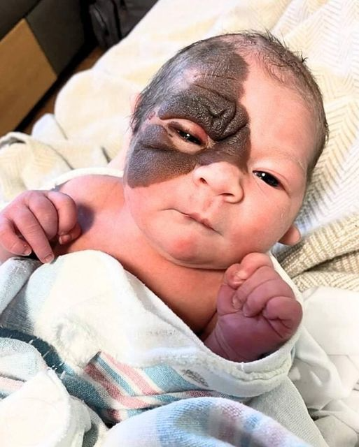 Mom wants to show 13-month-old daughter with rare birthmark that she is ...