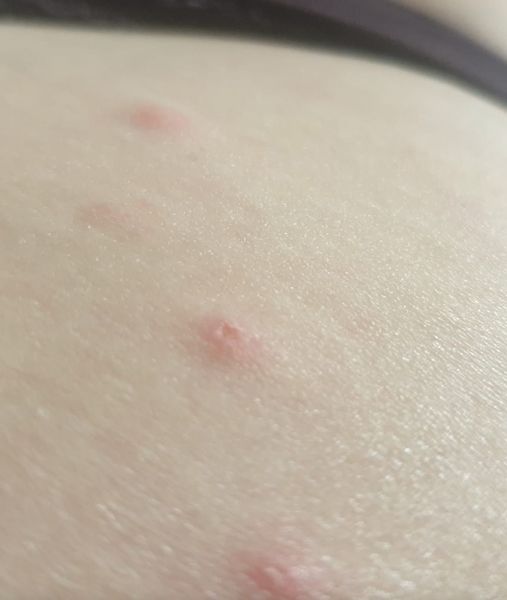 How To Identify 10 Of The Most Common Bug Bites - Weveryday Stories