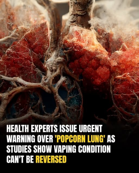 Urgent Alert: Vaping-Linked ‘Popcorn Lung’ Causes Lasting Harm, Experts ...