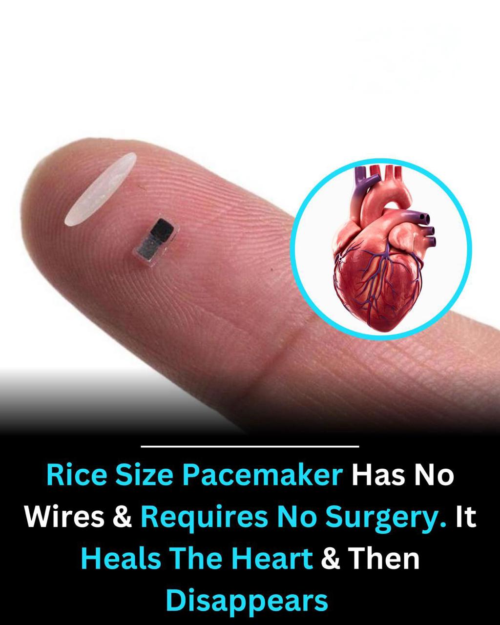 World’s Smallest Pacemaker, the Size of a Rice Grain, Marks Major ...