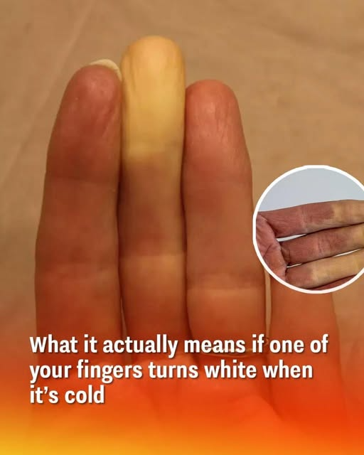 What It Means If Your Fingers Turn White When It’s Cold - Weveryday Stories
