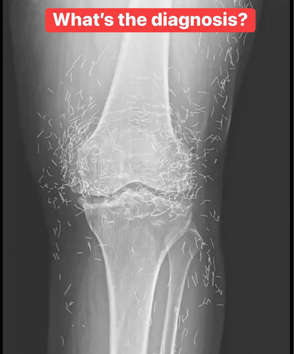 X-Ray Reveals Hundreds of Gold Needles in Woman’s Knees - Weveryday Stories