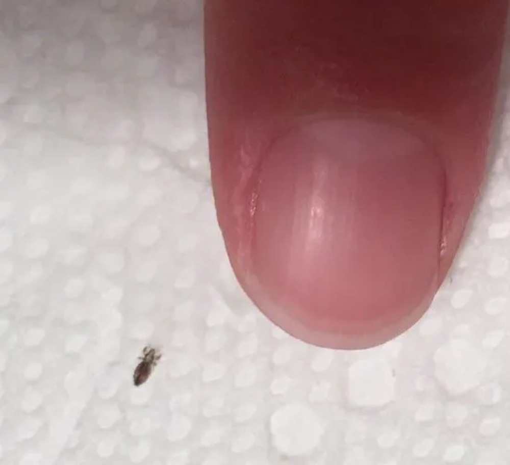 If you find this bug in your hair, you must read this - Weveryday Stories